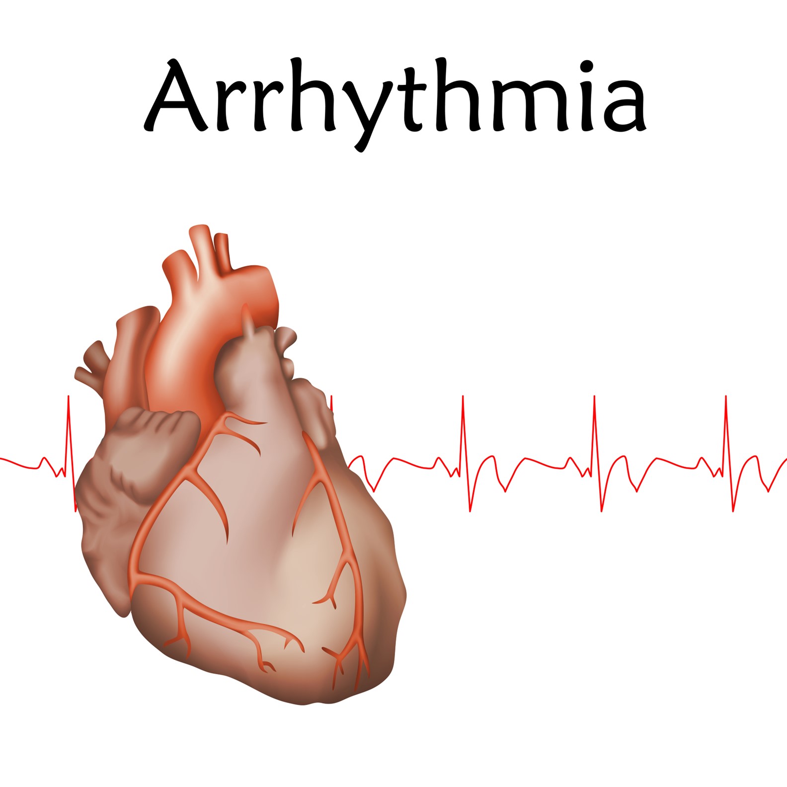 Understanding Arrhythmias: What You Need to Know - Dr. Vinod Kumar Manikala