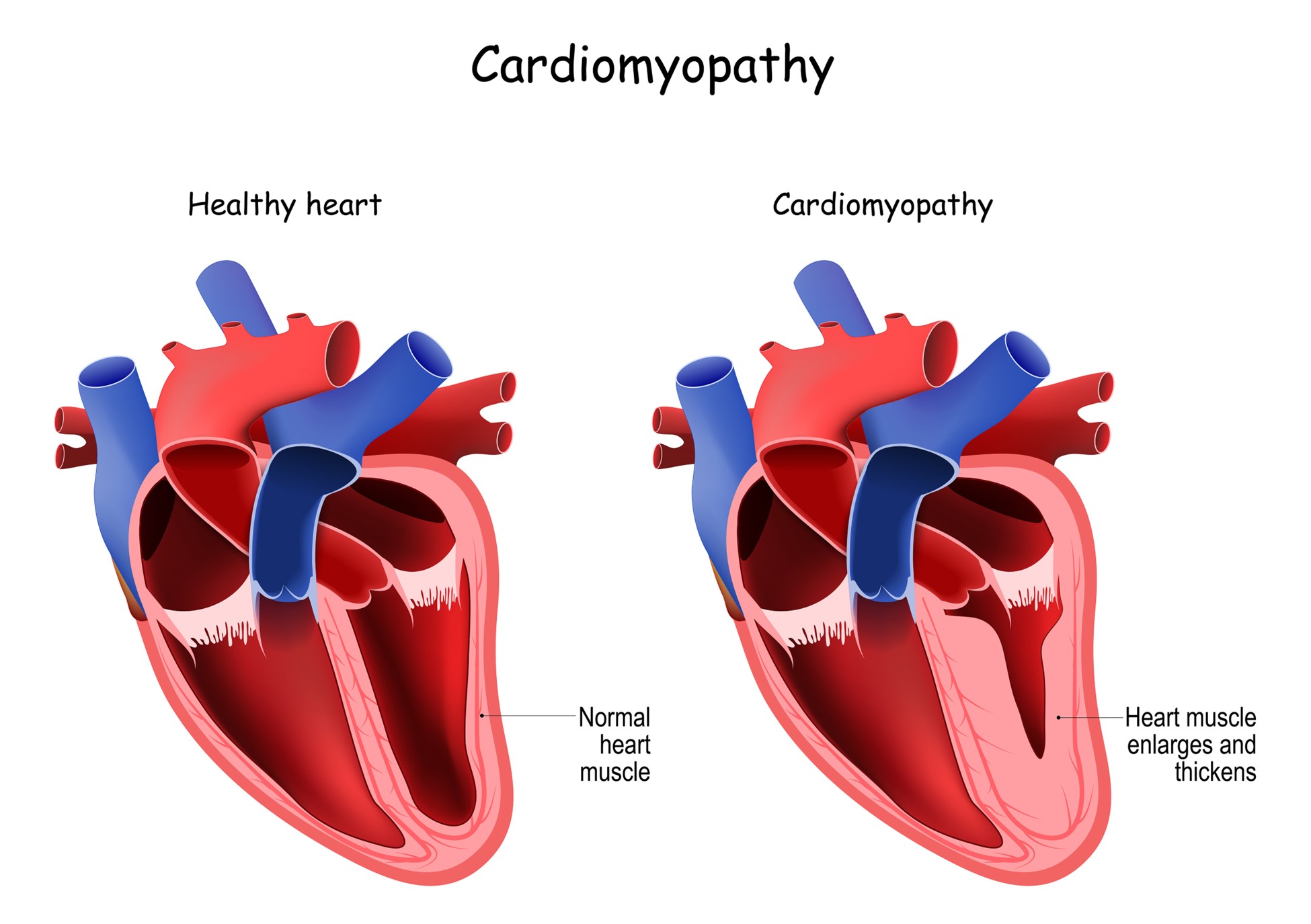 Understanding Cardiomyopathy - Dr. Vinod Kumar Manikala